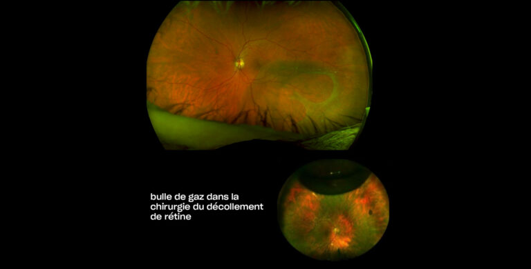 Chirurgie du décollement de la rétine - Centre Ophtalmologique Plaisir ...